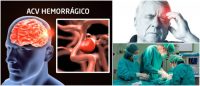 ACV Hemorrágico: ¿Qué es? Causas, Factores de Riesgo, Síntomas ...