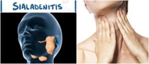 Sialadenitis o Inflamación de las Glándulas Salivales: Clasificación ...