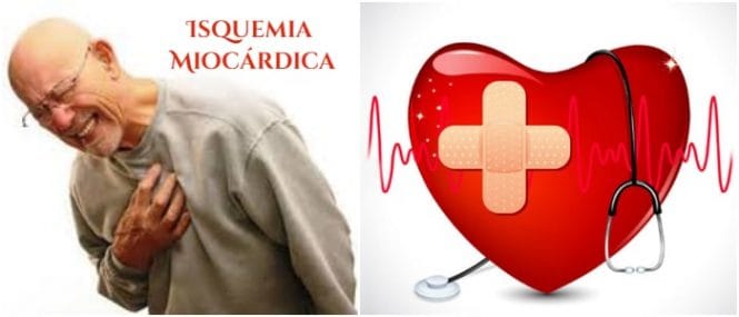 Isquemia Miocárdica o Cardiopatía Isquémica: Causas, Síntomas ...