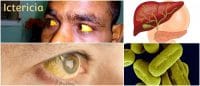 Ictericia: Definición, Tipos, Causas, Síntomas, Factores de Riesgo ...