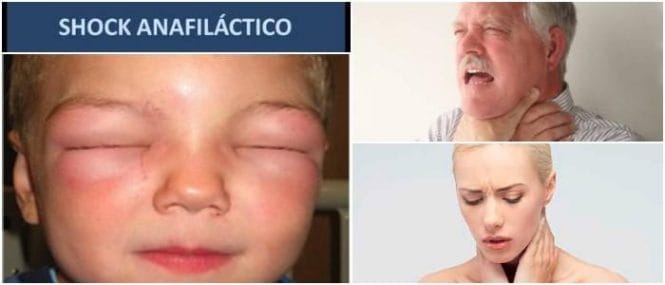 Choque o Shock Anafiláctico: Causas, Síntomas, Diagnóstico, Tratamiento ...