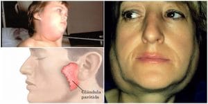 Parotiditis: Síntomas, Causas, Factores de Riesgo y Tratamiento ...