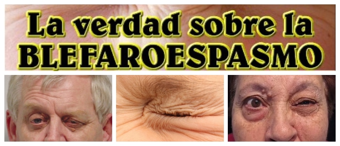 Blefaroespasmo: Tipos, Causas, Síntomas, Diagnóstico y Tratamiento
