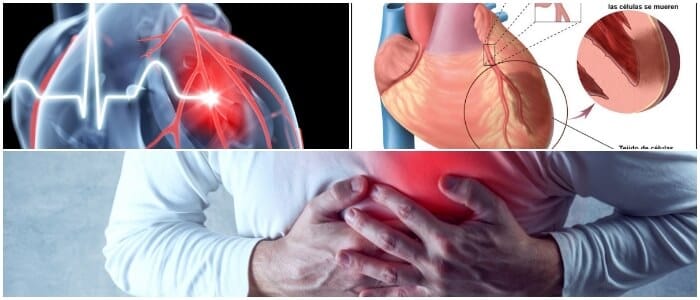Preinfarto: Causas, Síntomas, Diagnóstico y Tratamiento