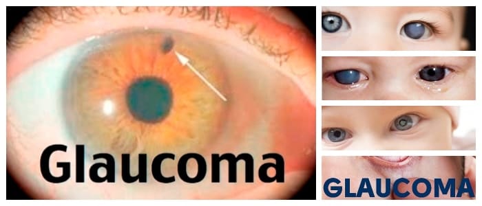 Glaucoma Congénito: Tipos, Síntomas, Causas, Signos, Tratamiento y ...