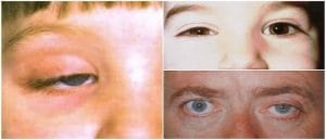 Síndrome de Horner: Causas, Síntomas, Diagnóstico y Tratamiento