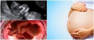 Acrania: ¿Qué Es? Causas, Síntomas, Diagnóstico y Tratamiento