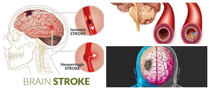 Derrame Cerebral ¿qué Es Síntomas Factores De Riesgo Causas Y