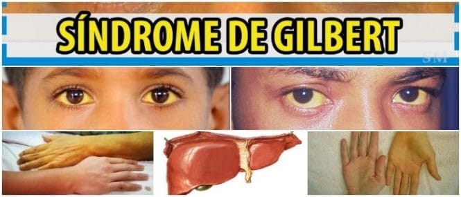 Síndrome De Gilbert: Síntomas, Causas, Diagnóstico, Tratamiento y ...