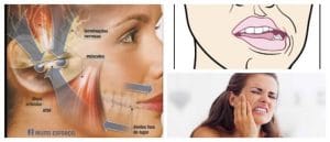 Trismo: Clasificación, Causas, Síntomas, Diagnóstico y Tratamiento