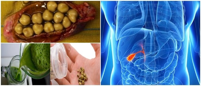 Vesícula Inflamada: ¿Qué Es? Causas, Síntomas, Diagnóstico ...