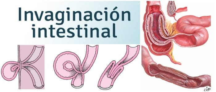 Invaginaci n Intestinal Historia S ntomas Causas Fisiopatolog a Invaginaci n Intestinal Historia S ntomas Causas Fisiopatolog a