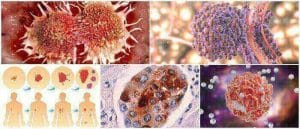 Metástasis: Definición, Síntomas, Desarrollo, Rutas De Propagación ...