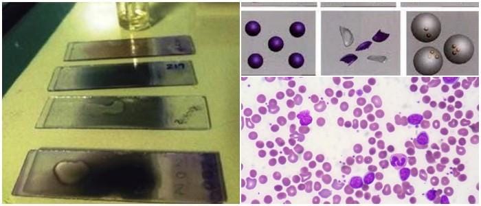 Esquistocitos: Definición, Causas, Síntomas, Diagnóstico y Tratamiento