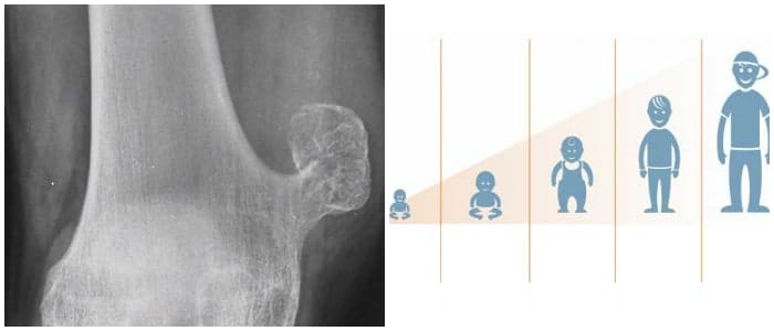 Osteocondroma: Tipos, Causas, Síntomas, Diagnóstico y Tratamiento