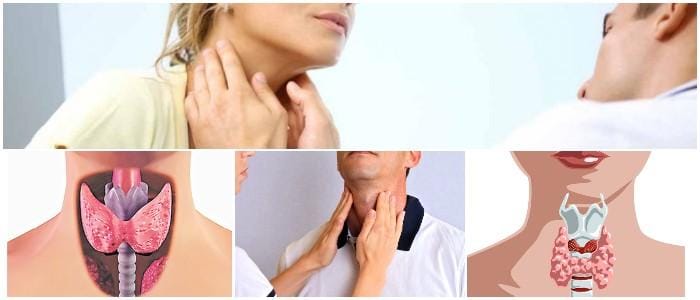 Tiroides Alta: ¿Qué es? Causas, Síntomas, Signos y Tratamiento