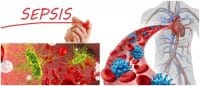 Sepsis: Causas, Complicaciones, Factores de Riesgo, Síntomas ...