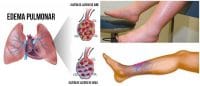 Edema: Tipos, Causas, Factores de Riesgo, Complicaciones, Diagnóstico y ...