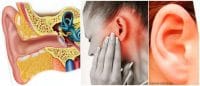 Otalgia: Definición, Causas, Síntomas, Diagnóstico, Tratamiento y ...