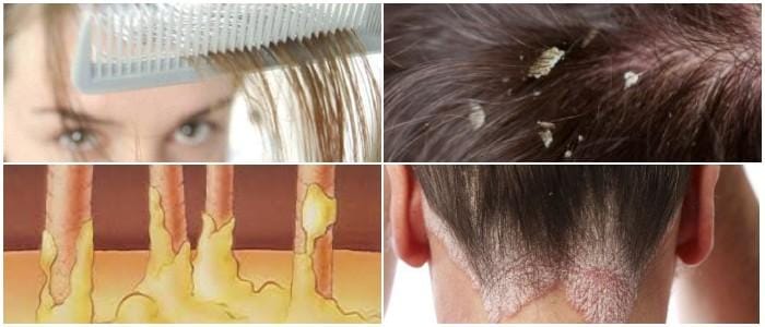 Seborrea: Causas, Factores de Riesgo, Síntomas, Diagnóstico ...