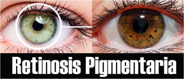 Retinosis Pigmentaria: Definición, Síntomas, Causas, Diagnóstico ...