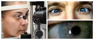 Iridodonesis: Definición, Causas, Síntomas, Diagnóstico y Tratamiento