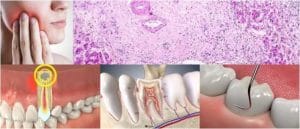 Absceso Periapical: Definición, Tipos, Causas, Síntomas, Complicaciones ...