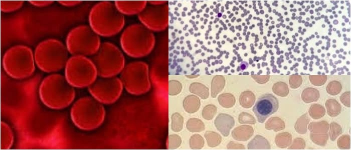 Policromasia: Definición, Características, Significación Clínica y ...